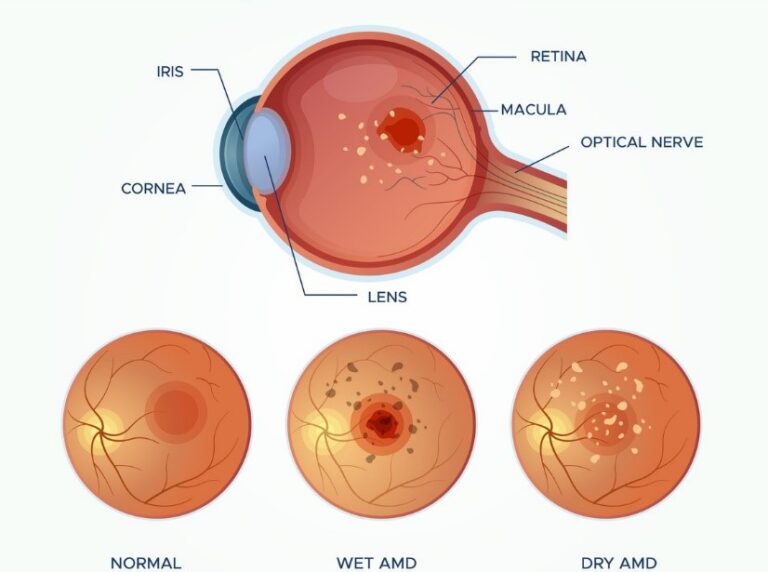 Macular Degeneration Explained: Symptoms, Types, and Risk Factors ...
